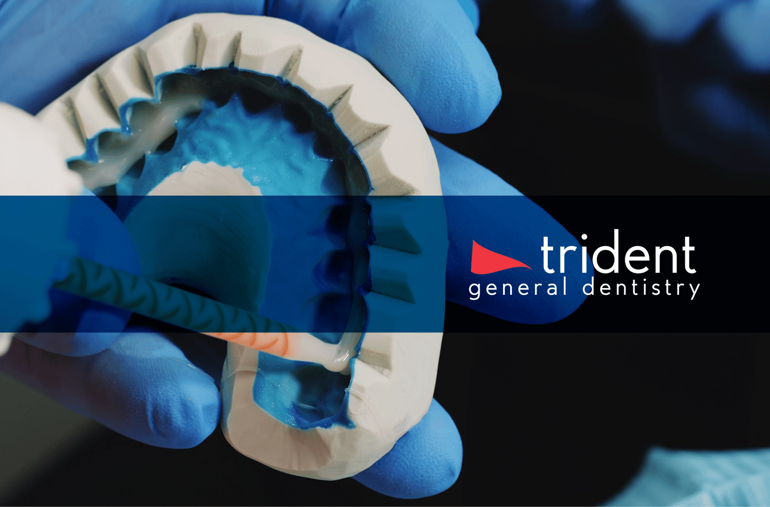 Pros and Cons of Dental Veneers — Carolina Periodontics